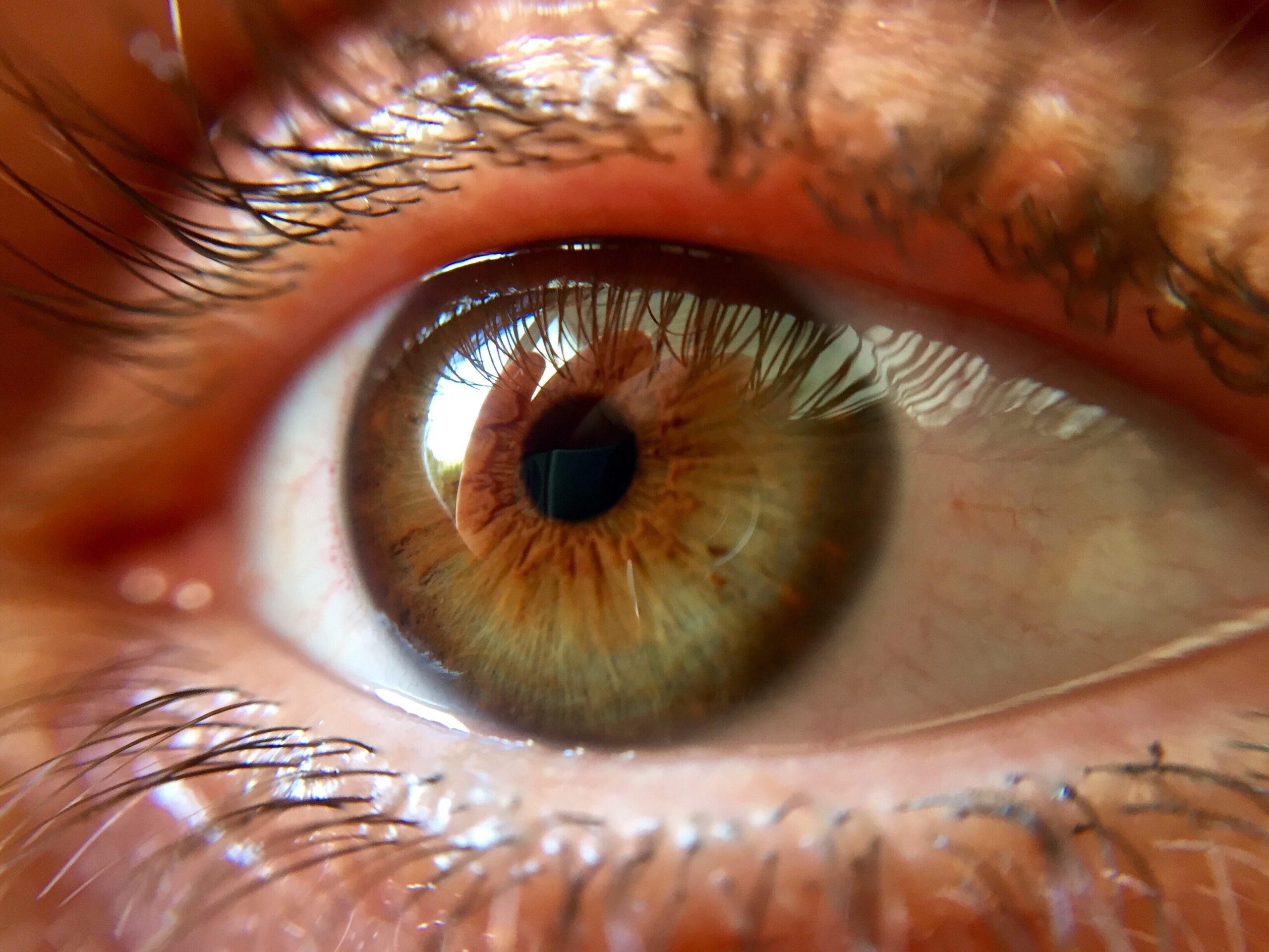 NIH researchers develop first stem cell model of albinism to study ... NIH researchers develop first stem cell model of albinism to study ...