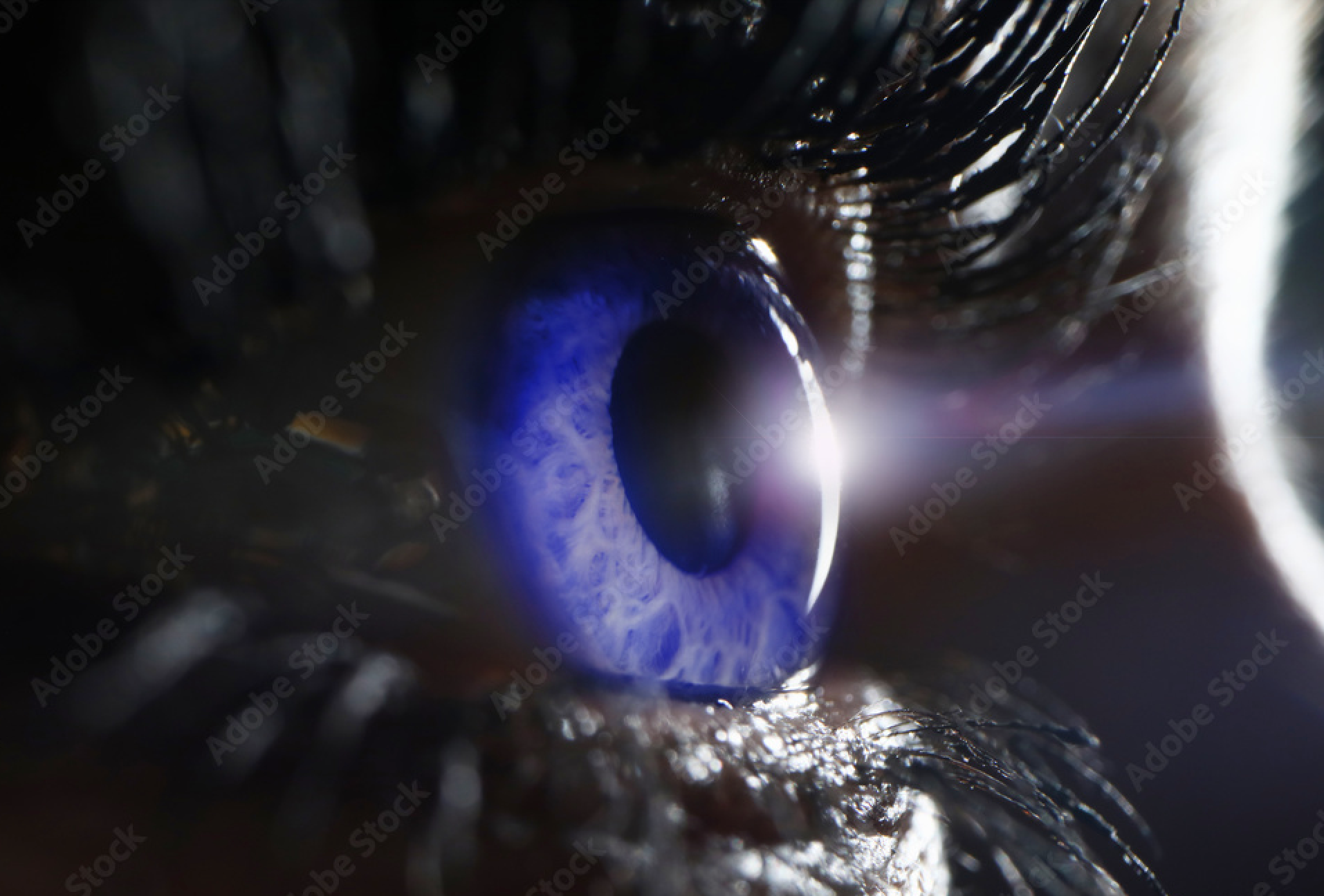 Seeing 'Rings' Around Lights: An Eye Condition that Could Lead to ...