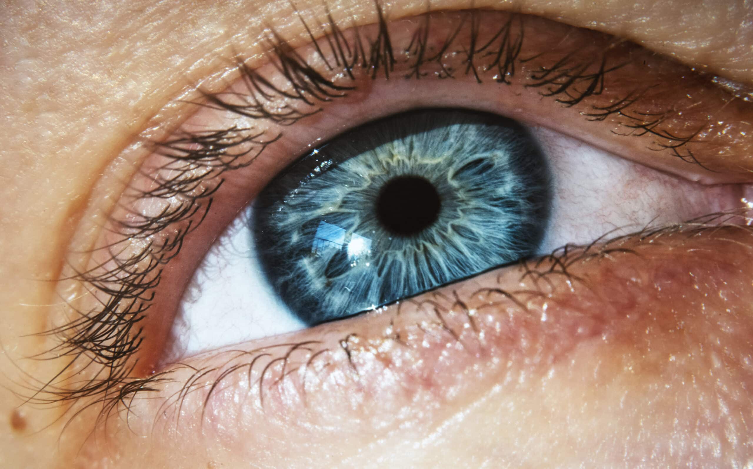Why Am I Seeing Yellow Spots? | Belmont Eye Center